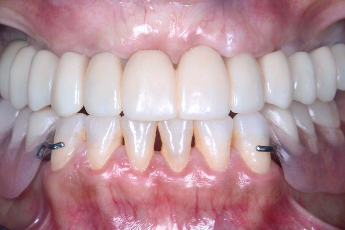 Full arch GBR using cerabone®, maxgraft® and Jason® membrane with ...