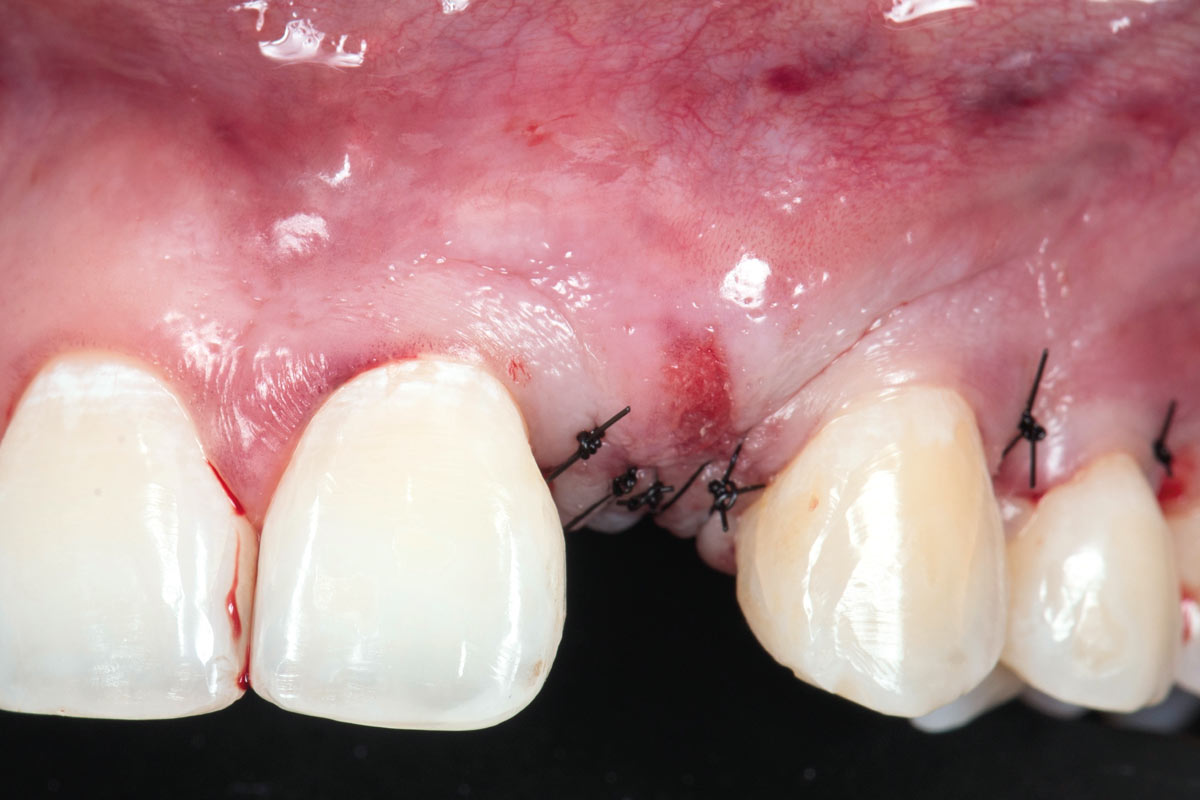 Horizontal ridge augmentation using cerabone® block, permamem® and ...
